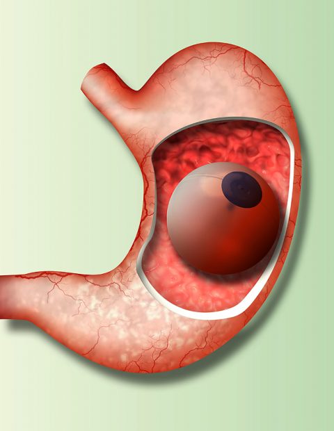Magenballon (6 Monate) - Krankenhaus Sachsenhausen